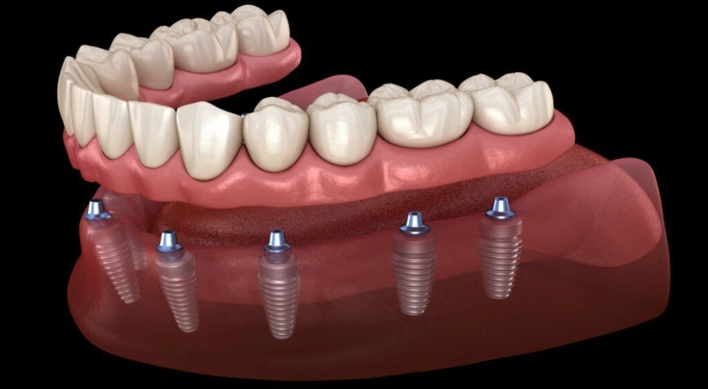 Full Mouth Rehabilitation in Vadodara - VIDS Dental Clinic